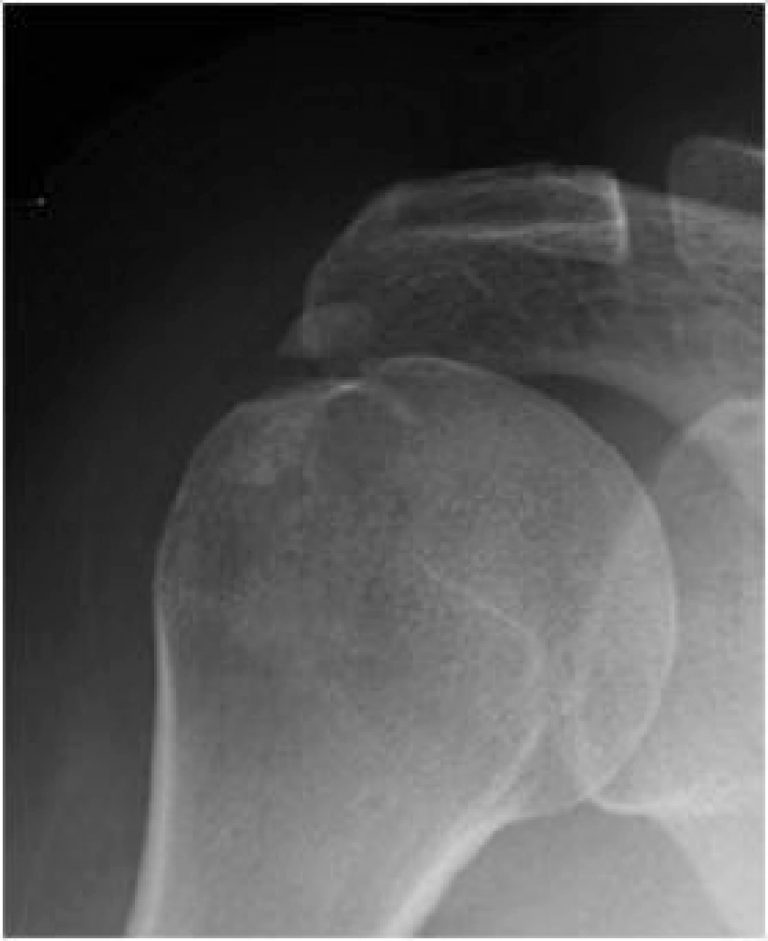 Enzo Silvestri: TRATTAMENTO PERCUTANEO DELLA TENDINITE CALCIFICA ...